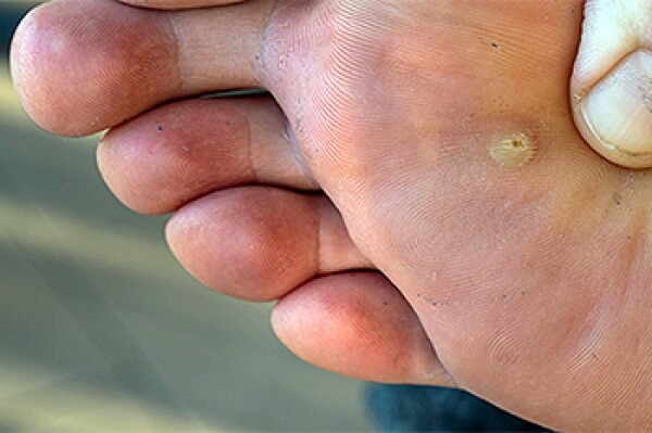 Black Dots Warts On Feet